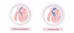 Varicocele: sintomas, causas, diagnóstico e tratamento